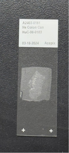 Human FFPE Neuroblastoma Cancer Tissue Slide (5-PK) | Acepix | Biomol.com